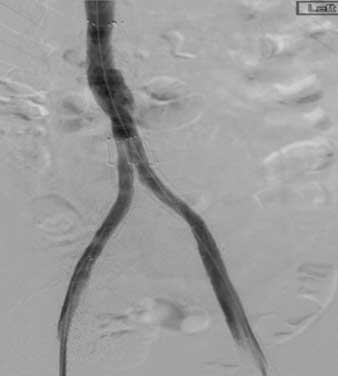 Deep Vein Thrombosis Treatment - VIR Chicago