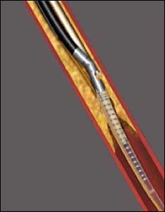 Peripheral Artery Disease - VIR Chicago